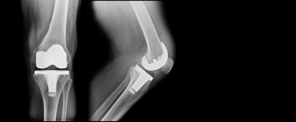 Total Joint Replacement - Mississippi Valley Surgery Center